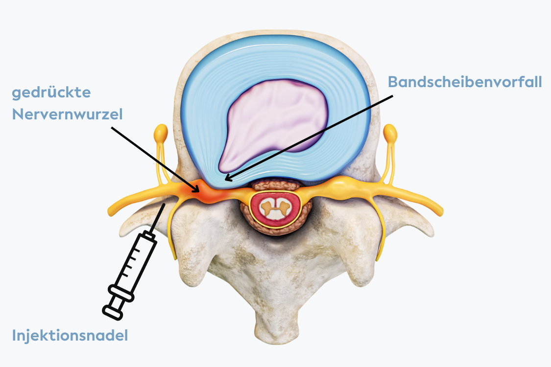 PRT-Spritze an LWS & HWS » Erfolgsquote & Nebenwirkungen