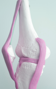 Meniskus-OP am Knie | Ambulante Meniskusriss-OP in München