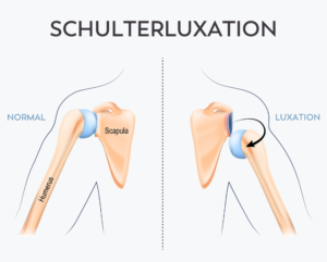 Schulterluxation (ausgekugelte Schulter) | OP & sanfte Therapie